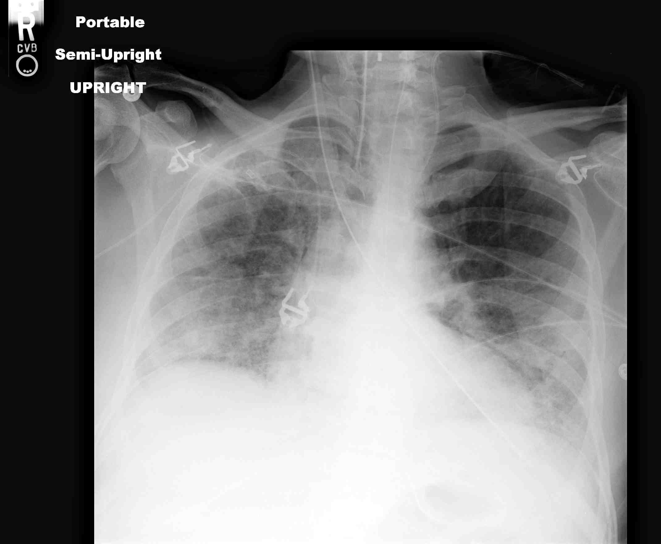 CXR-Pneumomediastinum – MD Nexus