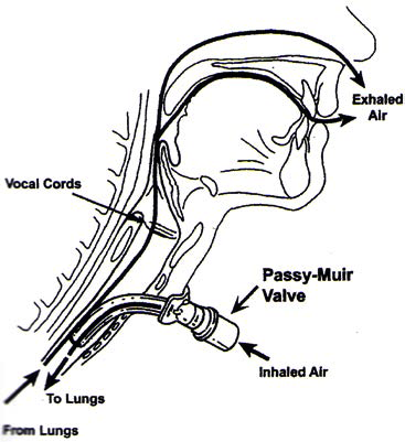 Tracheostomy | MD Nexus