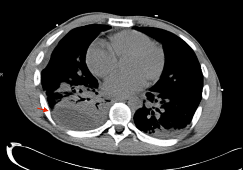 Pleural Effusion-Parapneumonic – MD Nexus