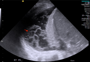 Pleural Effusion-Parapneumonic – MD Nexus